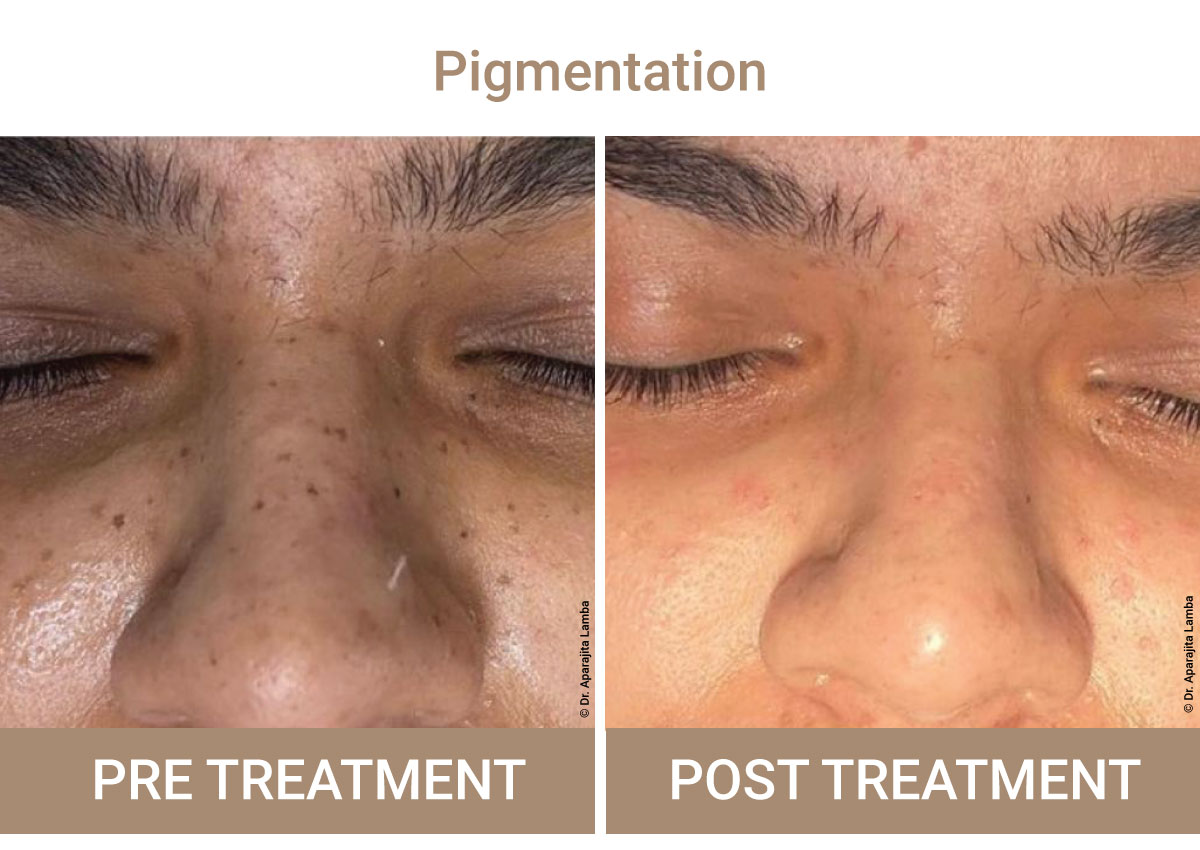 Pigmentation Treatment In Delhi | Iksana Wellness Hauz Khas
