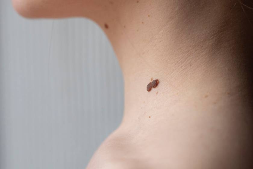Skin Tags Removal for Clear Skin | Iksana Wellness